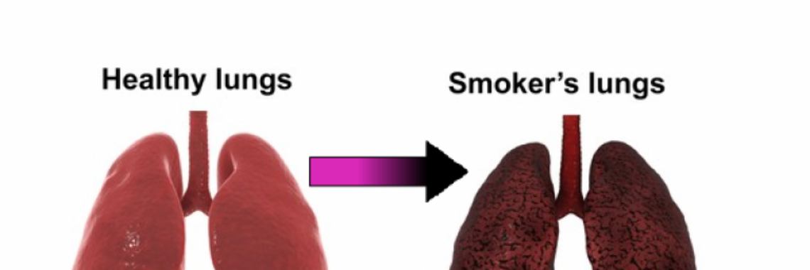 Healthy Lungs Vs. Smoker Lungs - Yoors Healthy Lungs Vs. Smoker Lungs - Yoors